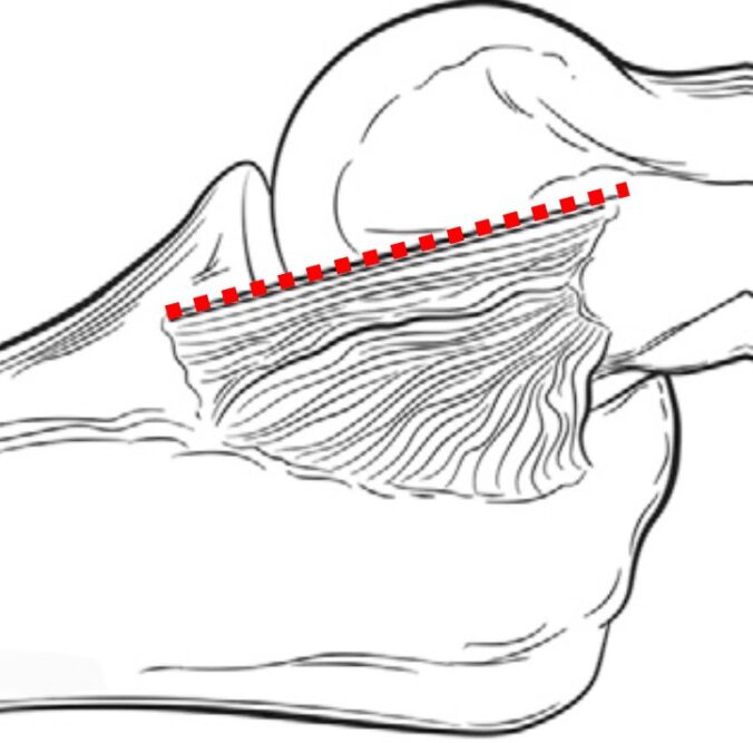 投球肘内側痛のストレステスト Moving Valgus Stress Test – ウォーターホルダー