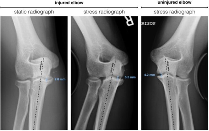 投球肘内側痛のストレステスト Moving Valgus Stress Test – ウォーターホルダー